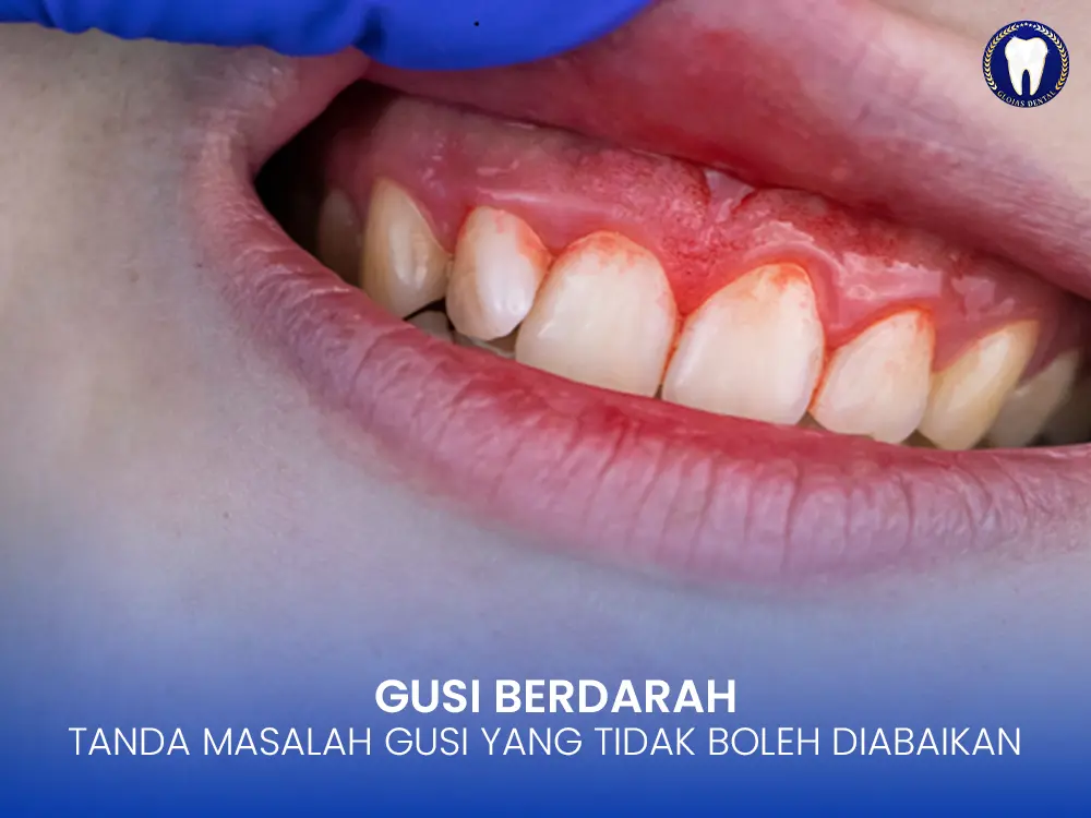 Gusi Berdarah: Punca, Rawatan & Cara Mengatasinya