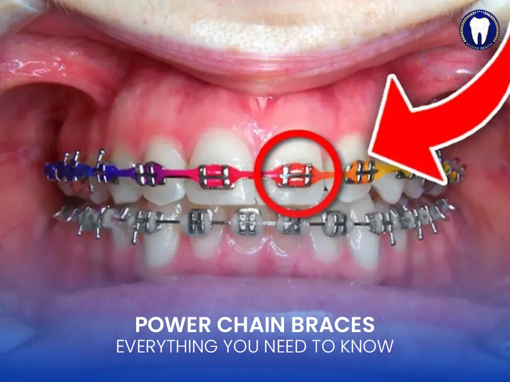 Power Chain Braces: Benefits, Cost & What To Expect