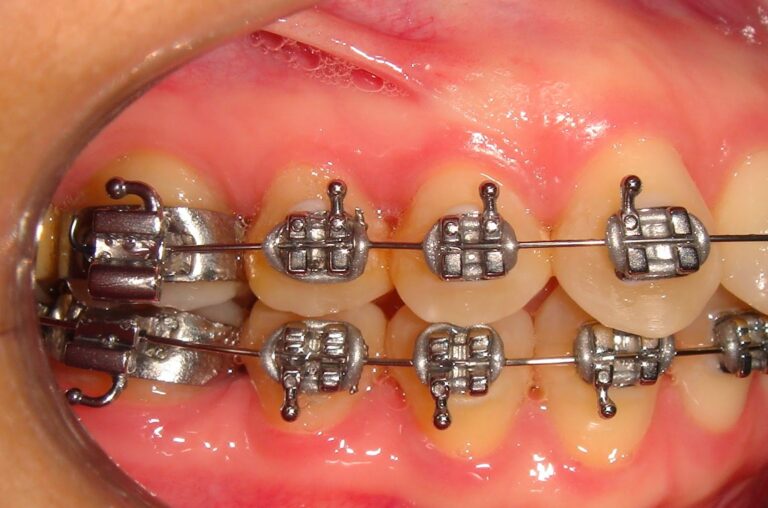 Bracket Braces: Types, Uses, Benefits, And Expert Guide