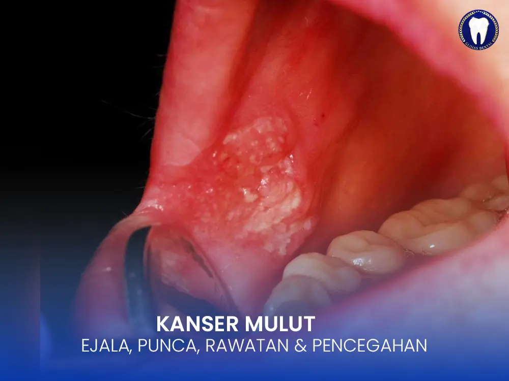 Kanser Mulut: Punca, Gejala & Rawatan Terbaik Di Malaysia